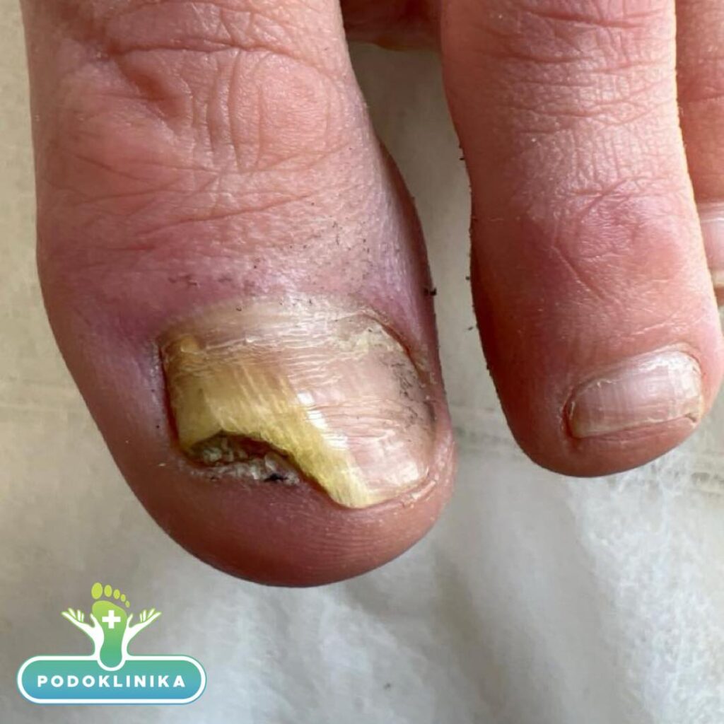 Nagų Grybelio Gydymas Vilniuje - Podoklinika.lt
