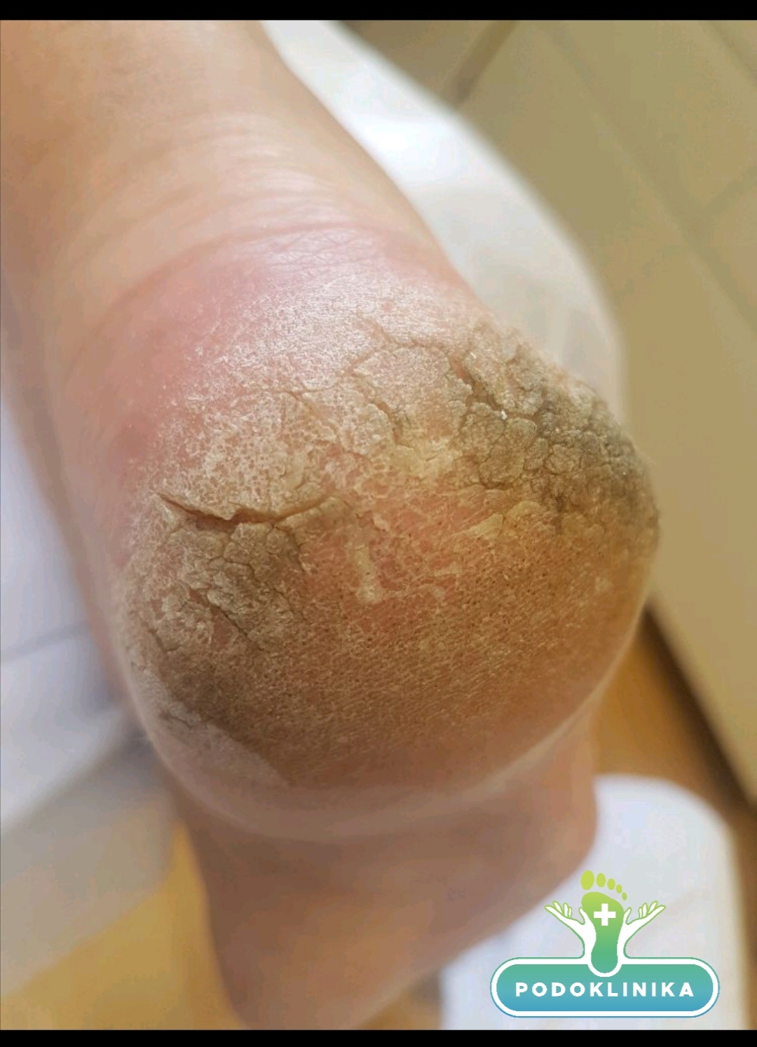 Gydomasis, Medicininis Pedikiūras - Kaina - Vilnius