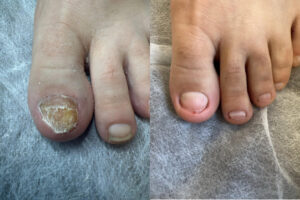 Kaip gydyti nagų grybelį? - Podoklinika.lt