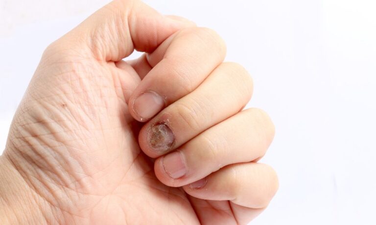 Rankų nagų grybelis: Simptomai, priežastys ir gydymas